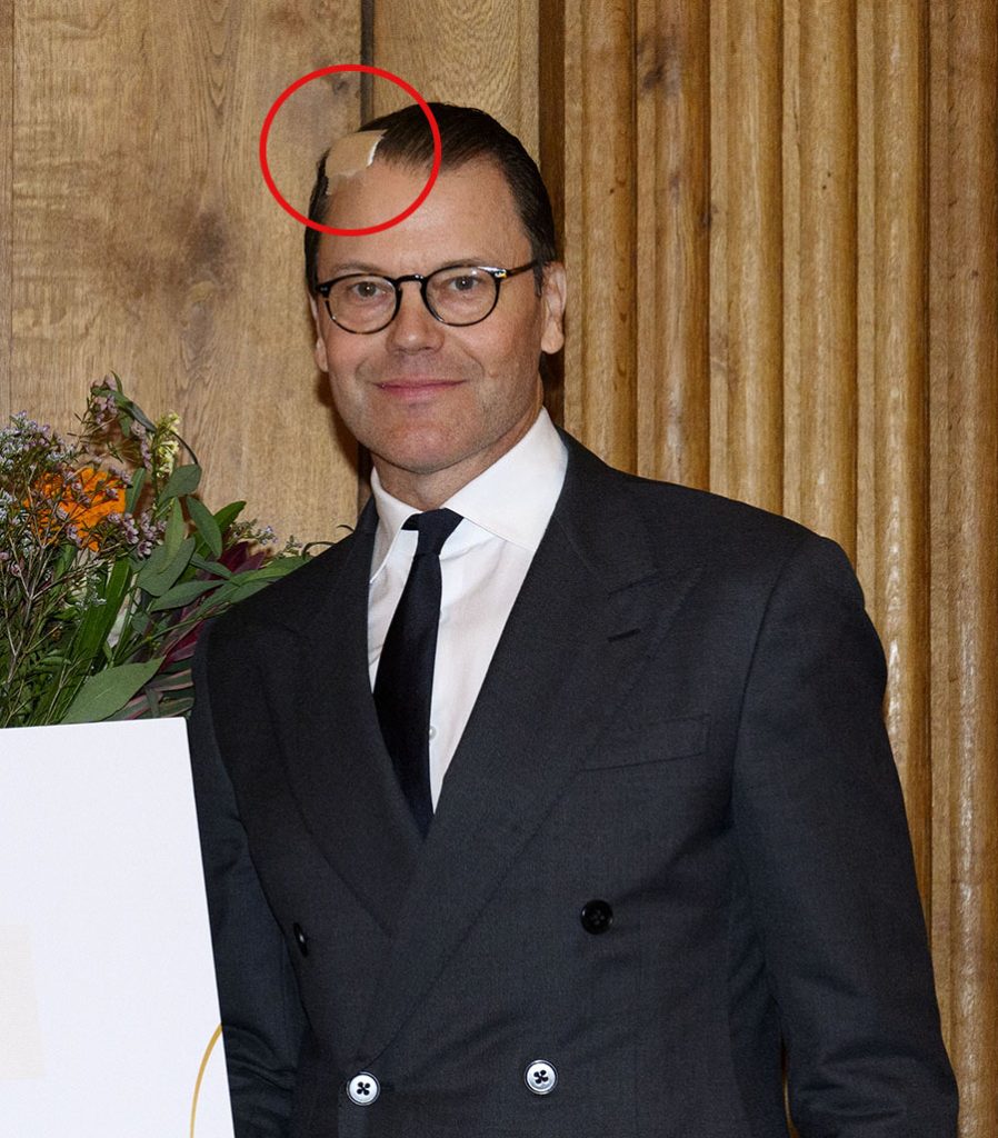 Prins Daniels ingrepp i ansiktet – allt avslöjat på bild